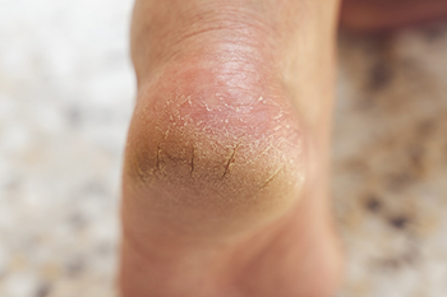 Internal and External Causes of Cracked Heels